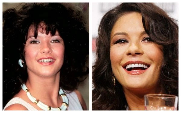 The evolution of the Hollywood smile: from temporary veneers to ...